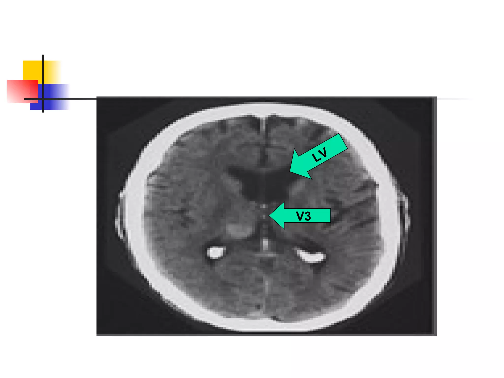 Ct brain basics and anatomy | PPT