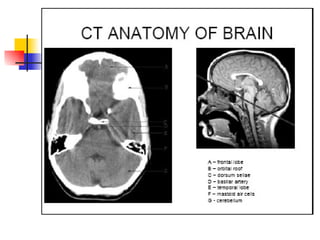 Ct brain basics and anatomy | PPT