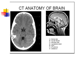 Ct brain basics and anatomy | PPT