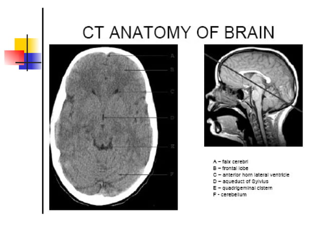 Ct brain basics and anatomy | PPT | Medical Tests | Medical Health