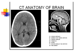 Ct brain basics and anatomy | PPT
