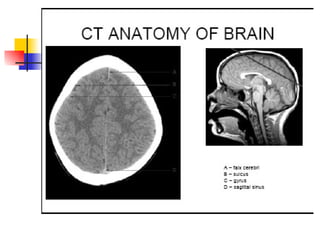 Ct brain basics and anatomy | PPT