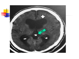 Ct brain basics and anatomy | PPT
