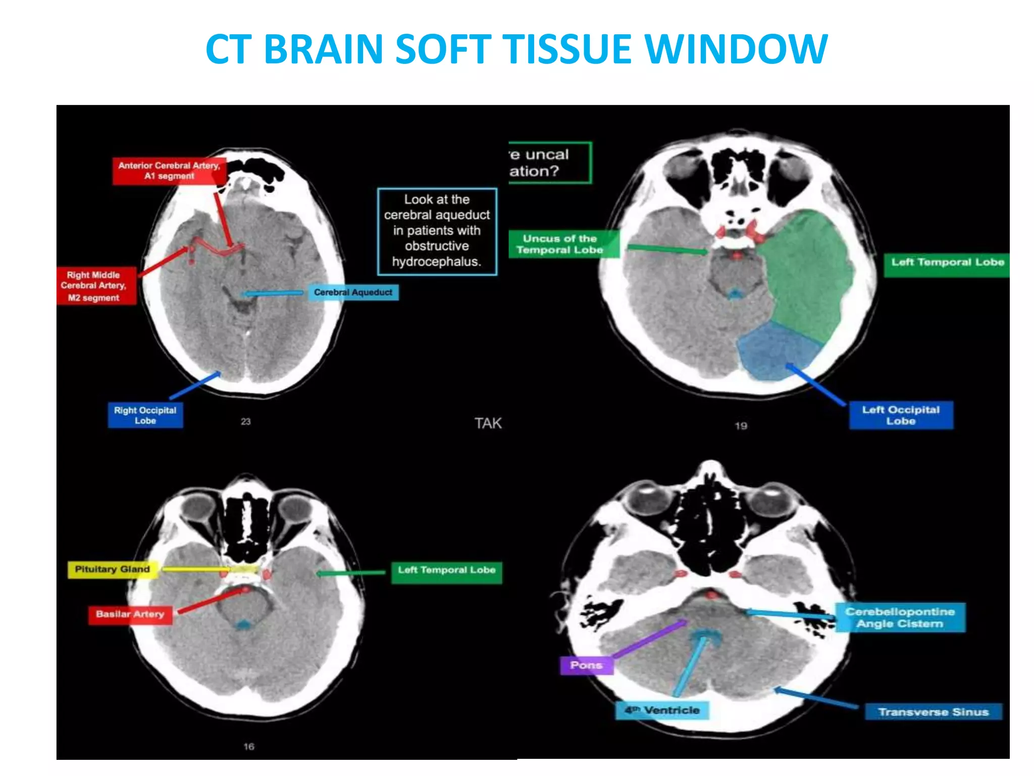 CT BRAIN ANATOMY.pptx
