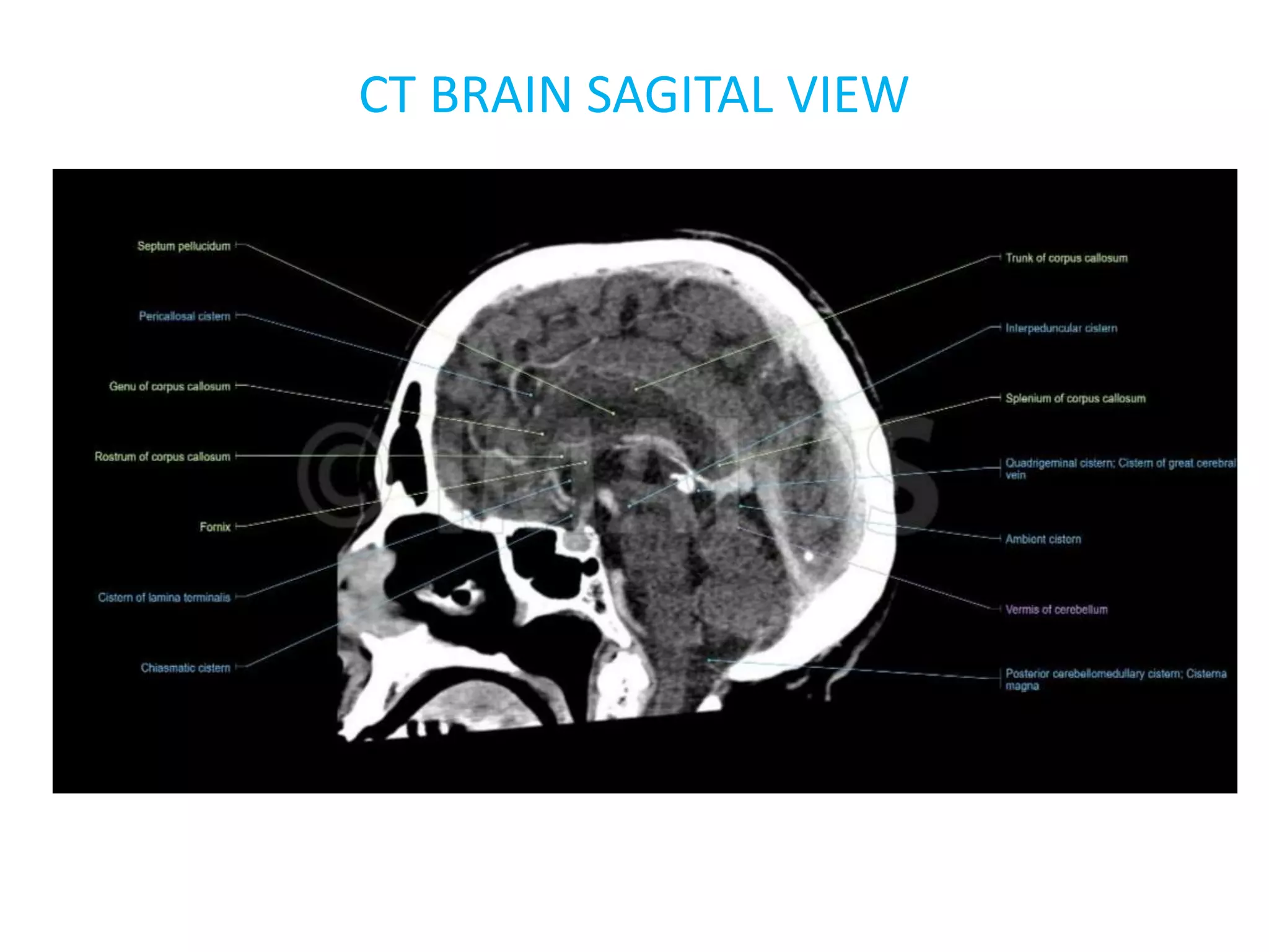 CT BRAIN ANATOMY.pptx