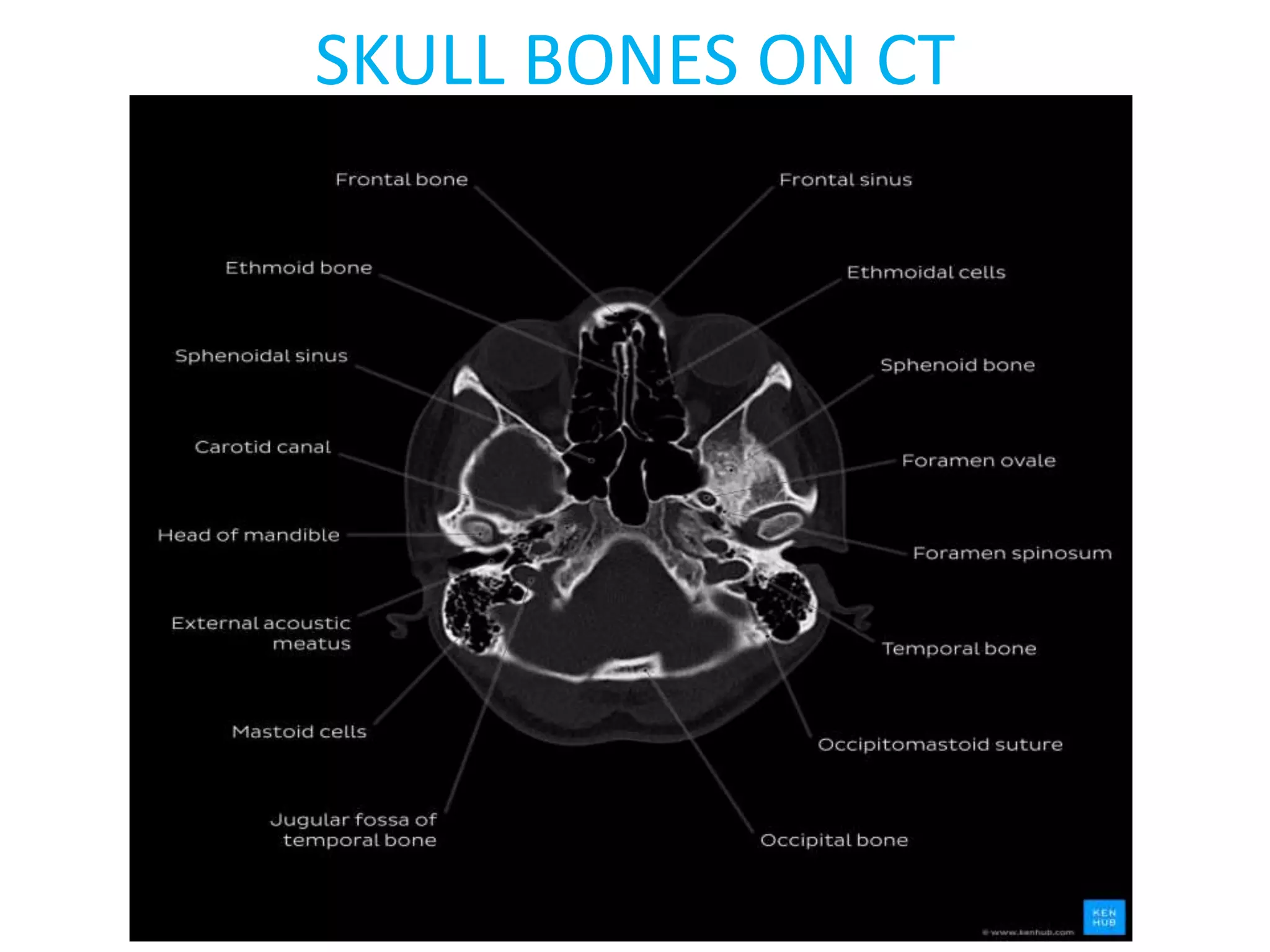 CT BRAIN ANATOMY.pptx