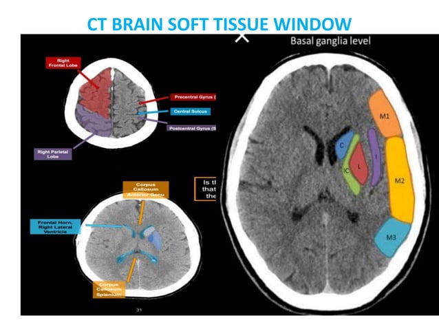 CT BRAIN ANATOMY.pptx | Brain and Nervous System Disorders | Diseases ...