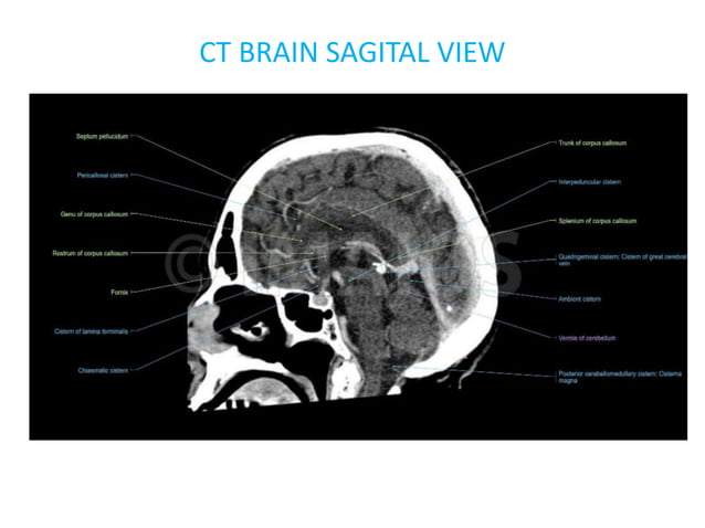 CT BRAIN ANATOMY.pptx | Brain and Nervous System Disorders | Diseases ...