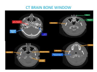 CT BRAIN ANATOMY.pptx | Brain and Nervous System Disorders | Diseases ...