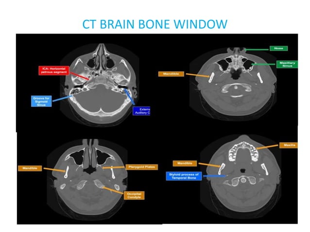 CT BRAIN ANATOMY.pptx | Brain and Nervous System Disorders | Diseases ...