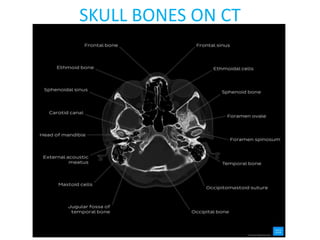 CT BRAIN ANATOMY.pptx