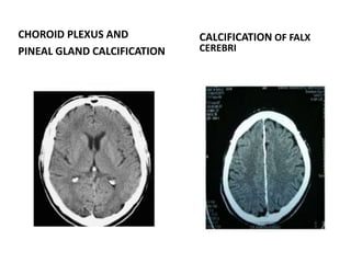 CT BRAIN ANATOMY.pptx | Brain and Nervous System Disorders | Diseases ...