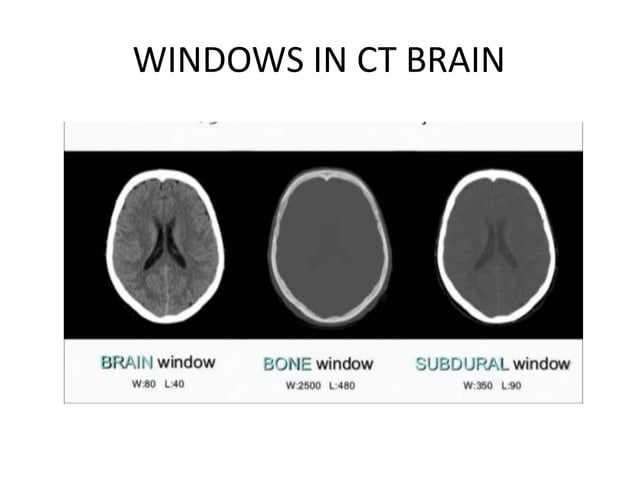 CT BRAIN ANATOMY.pptx | Brain and Nervous System Disorders | Diseases ...