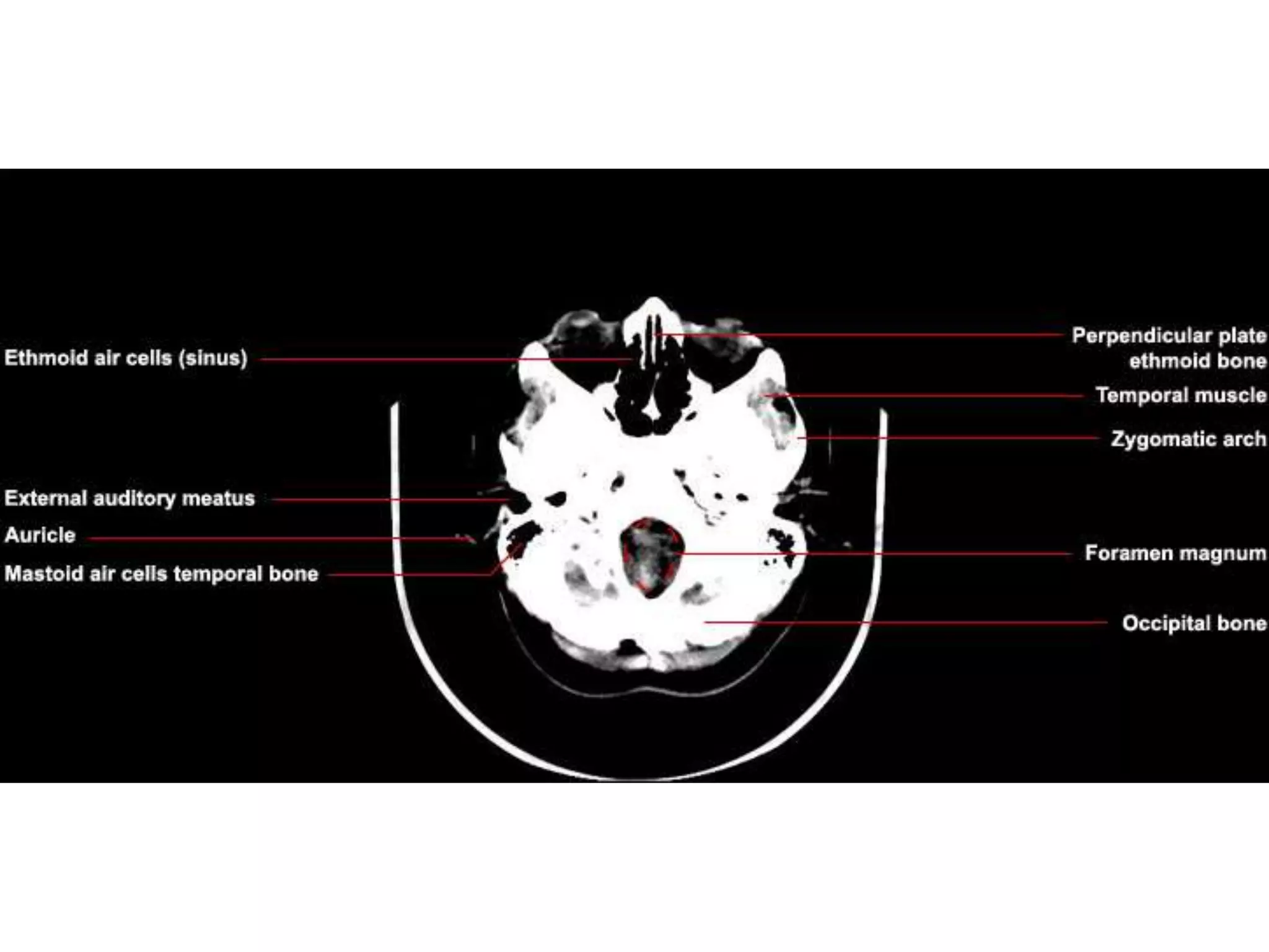 CT Brain Axial.pptx