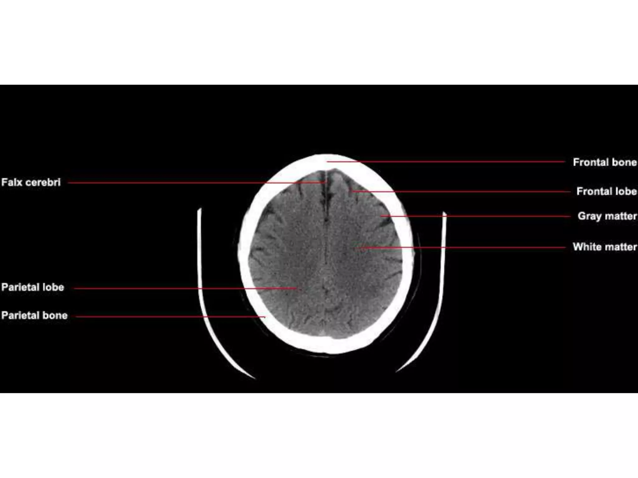 CT Brain Axial.pptx | Brain and Nervous System Disorders | Diseases and ...