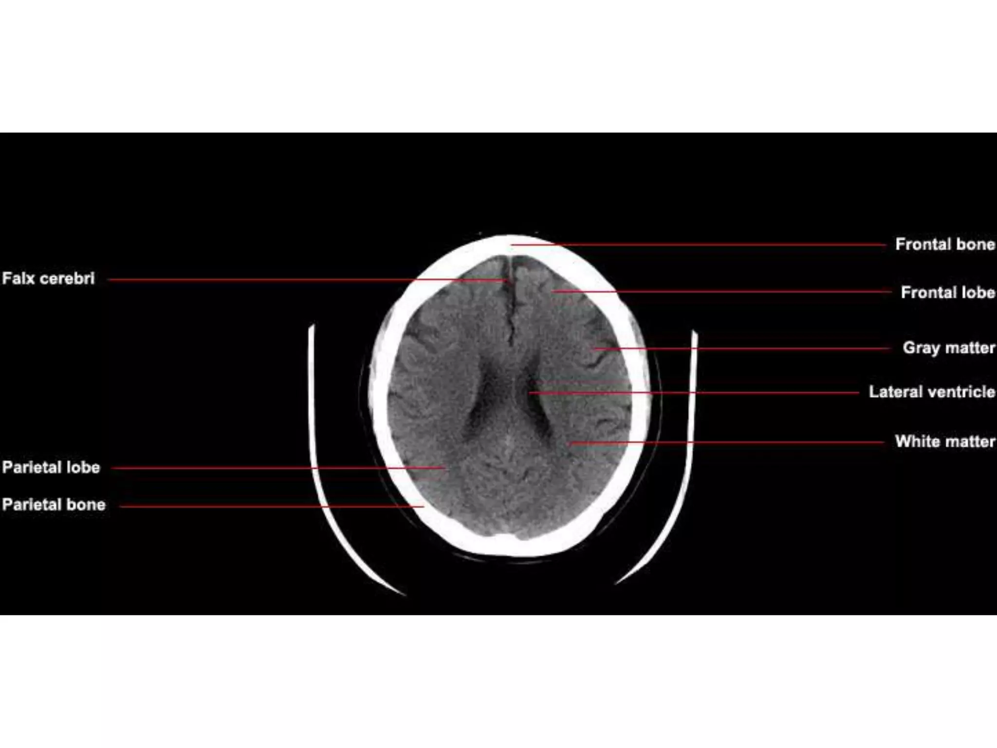 CT Brain Axial.pptx