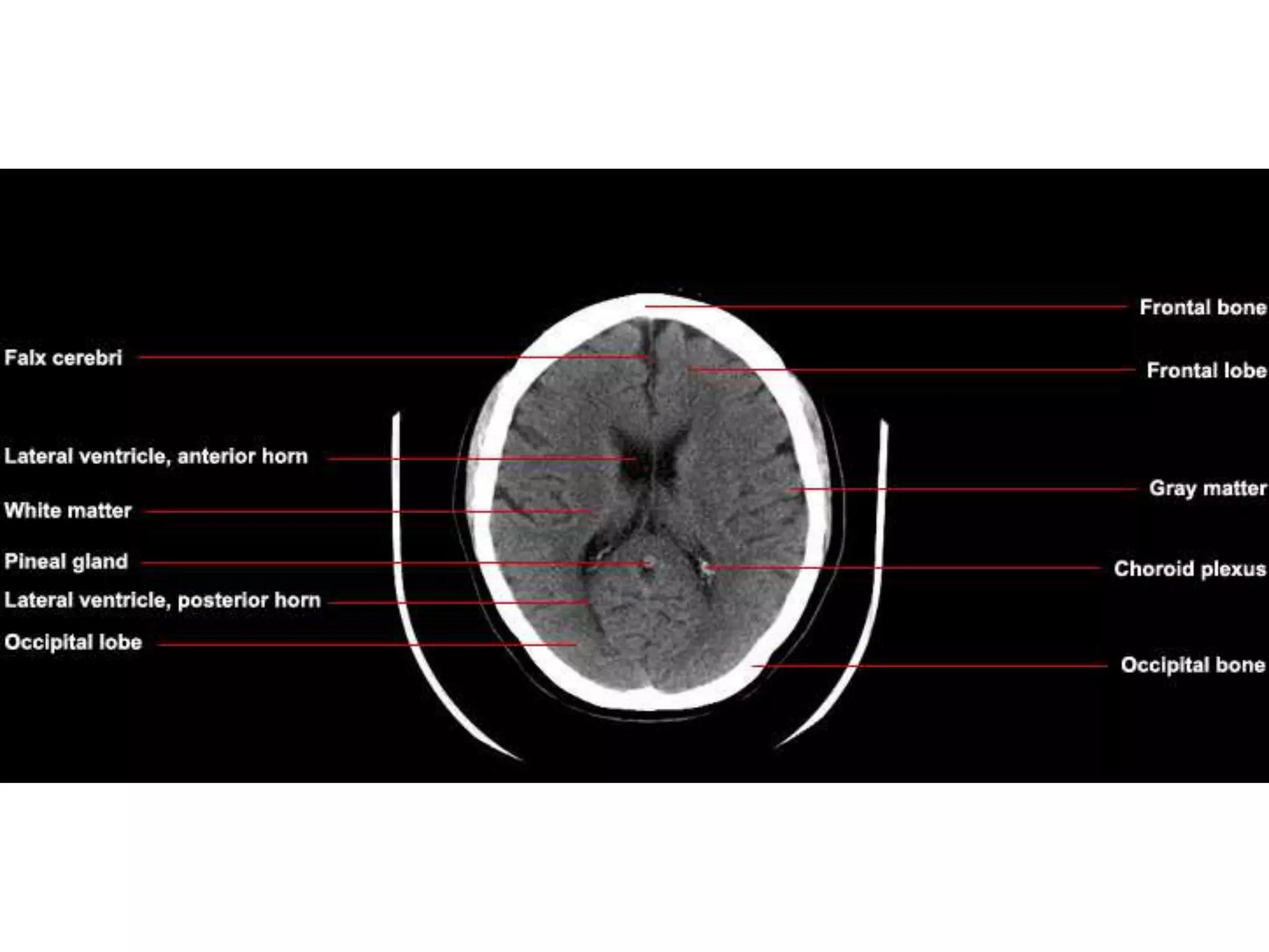 CT Brain Axial.pptx | Brain and Nervous System Disorders | Diseases and ...