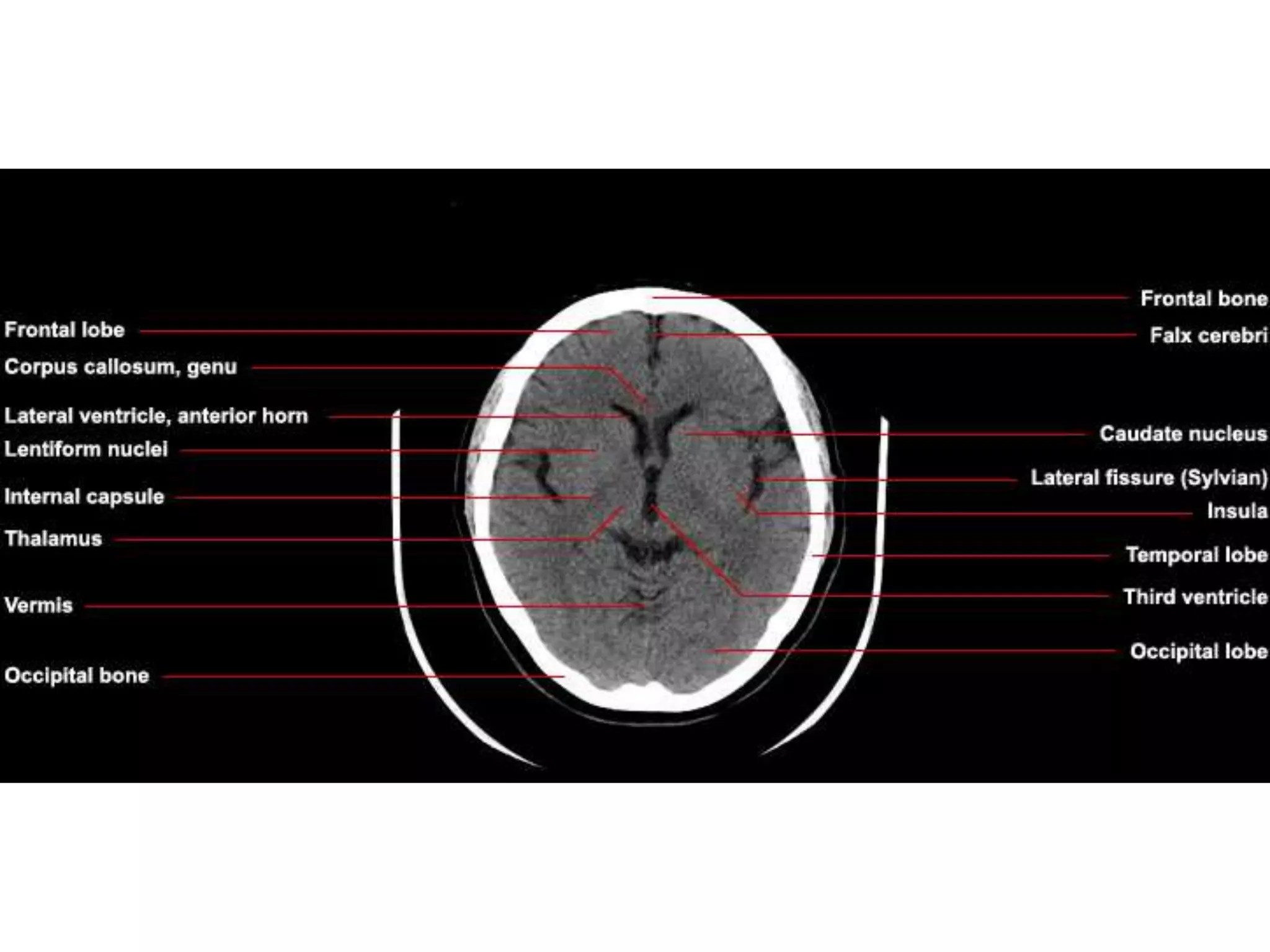 CT Brain Axial.pptx | Brain and Nervous System Disorders | Diseases and ...