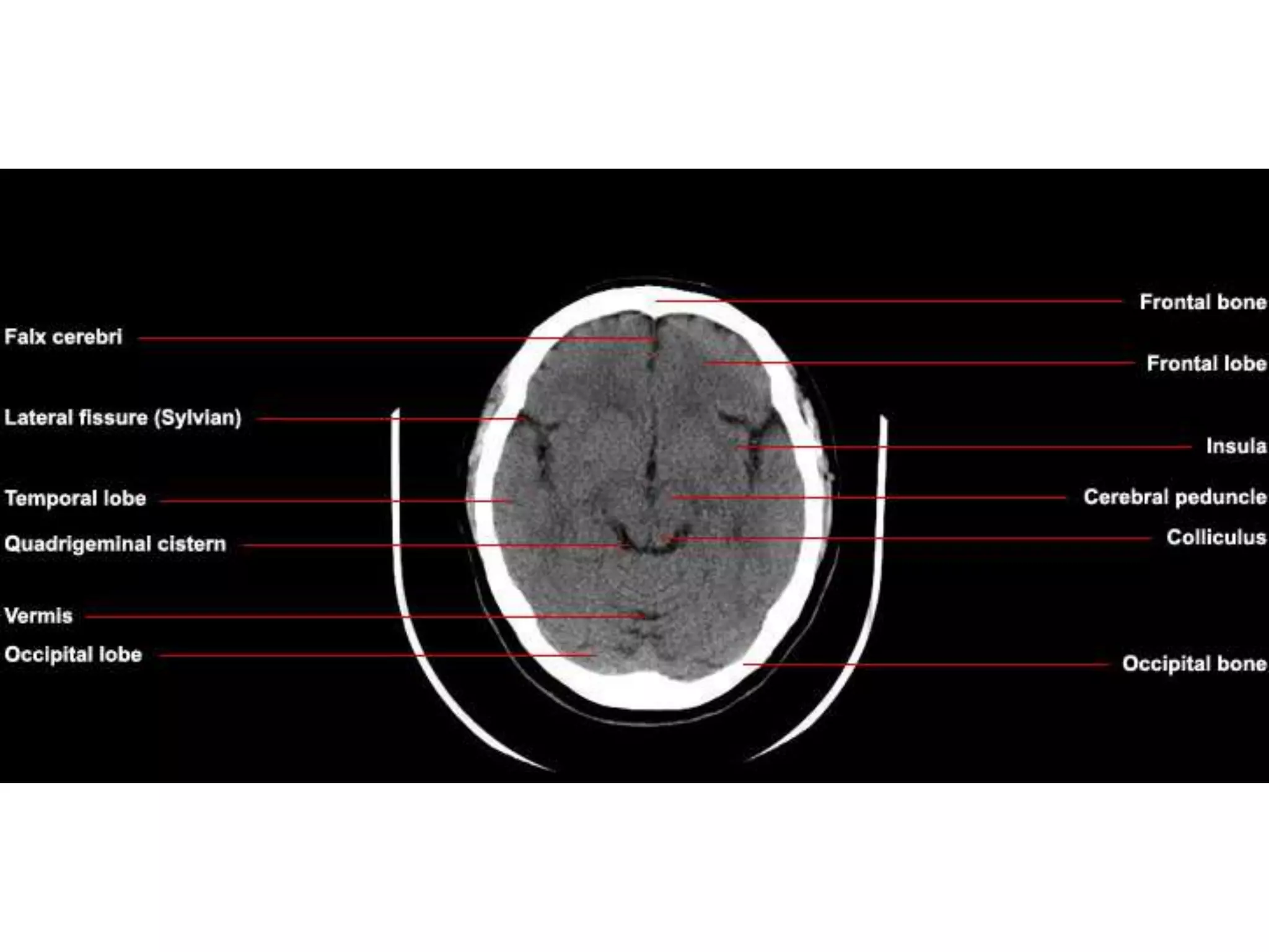 CT Brain Axial.pptx | Brain and Nervous System Disorders | Diseases and ...