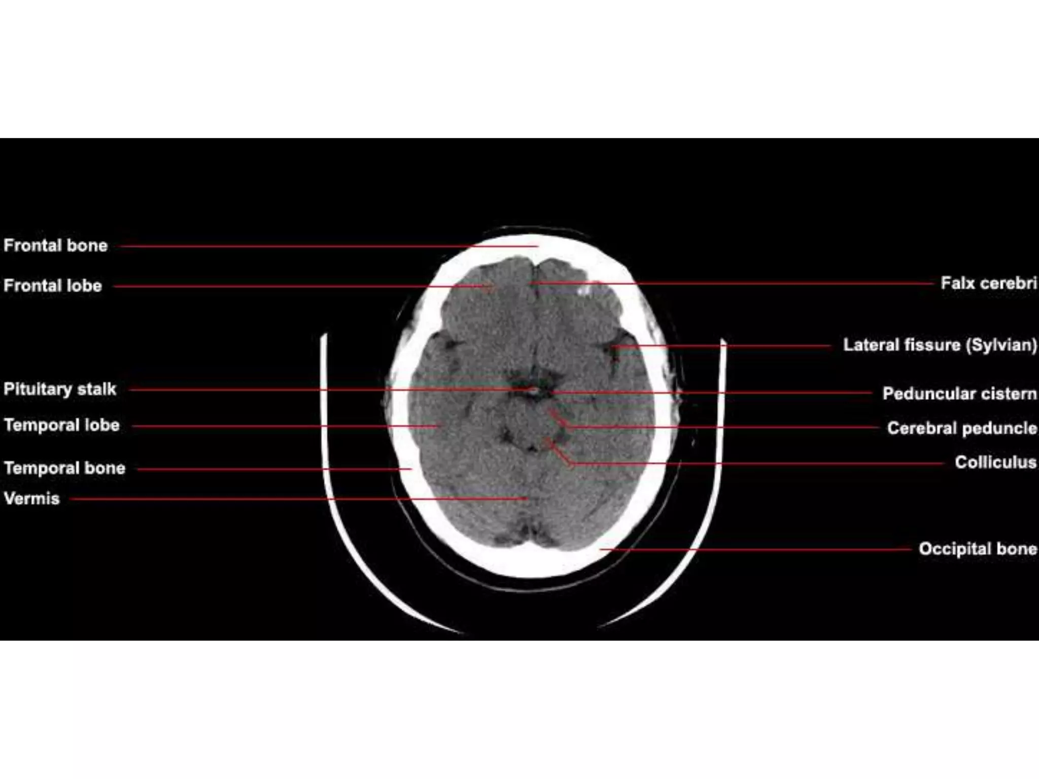 CT Brain Axial.pptx