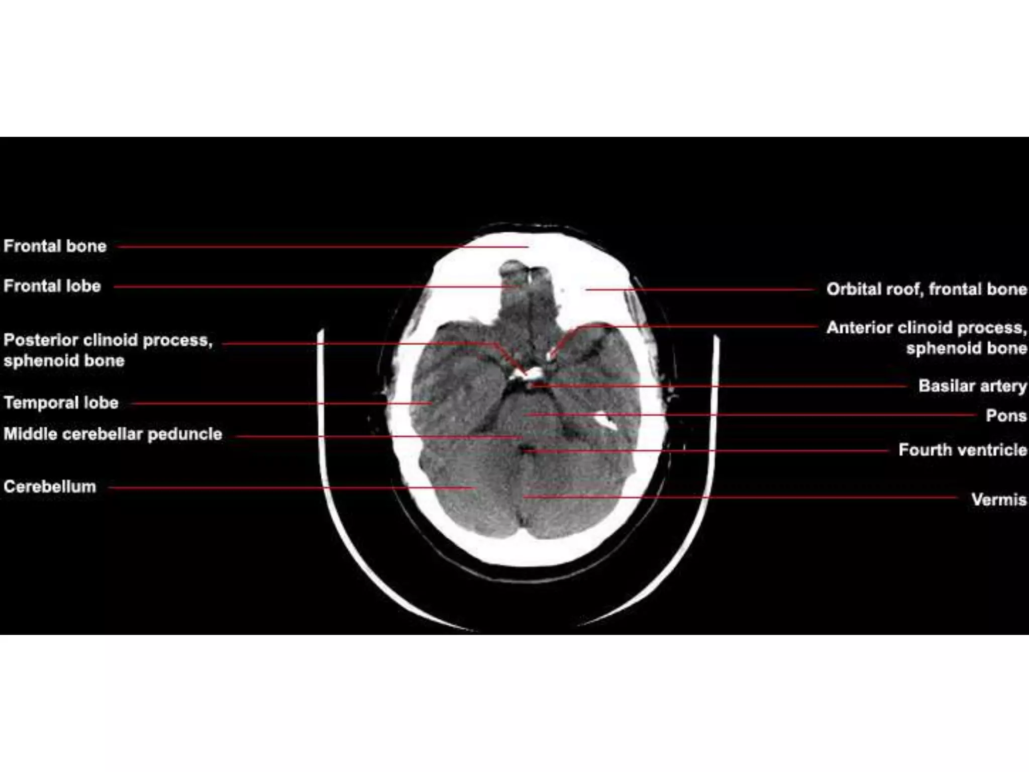 CT Brain Axial.pptx