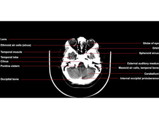 CT Brain Axial.pptx