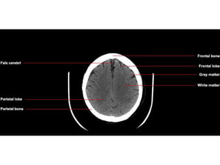 CT Brain Axial.pptx | Brain and Nervous System Disorders | Diseases and ...