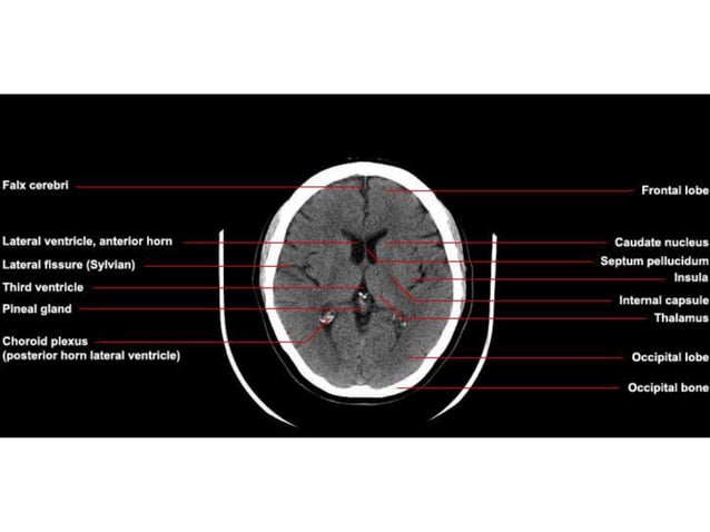CT Brain Axial.pptx | Brain and Nervous System Disorders | Diseases and ...
