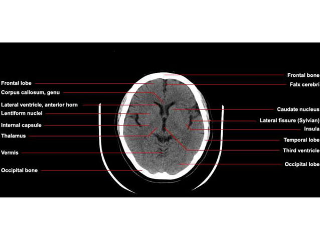 CT Brain Axial.pptx