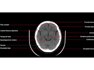 CT Brain Axial.pptx