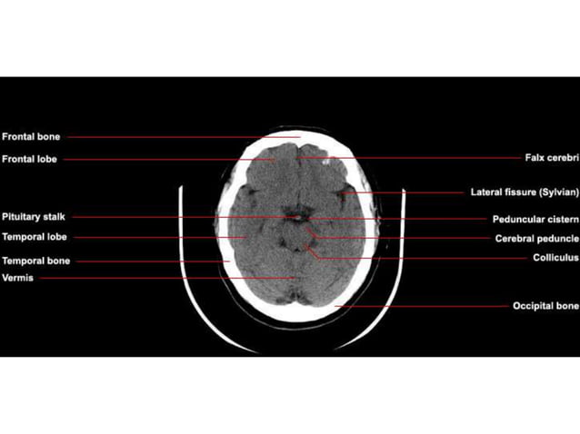 CT Brain Axial.pptx