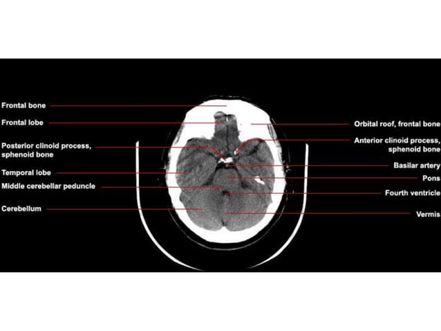 CT Brain Axial.pptx