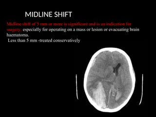 CT BRAIN IN ACUTE EMERGENCY dr sandra.pptx