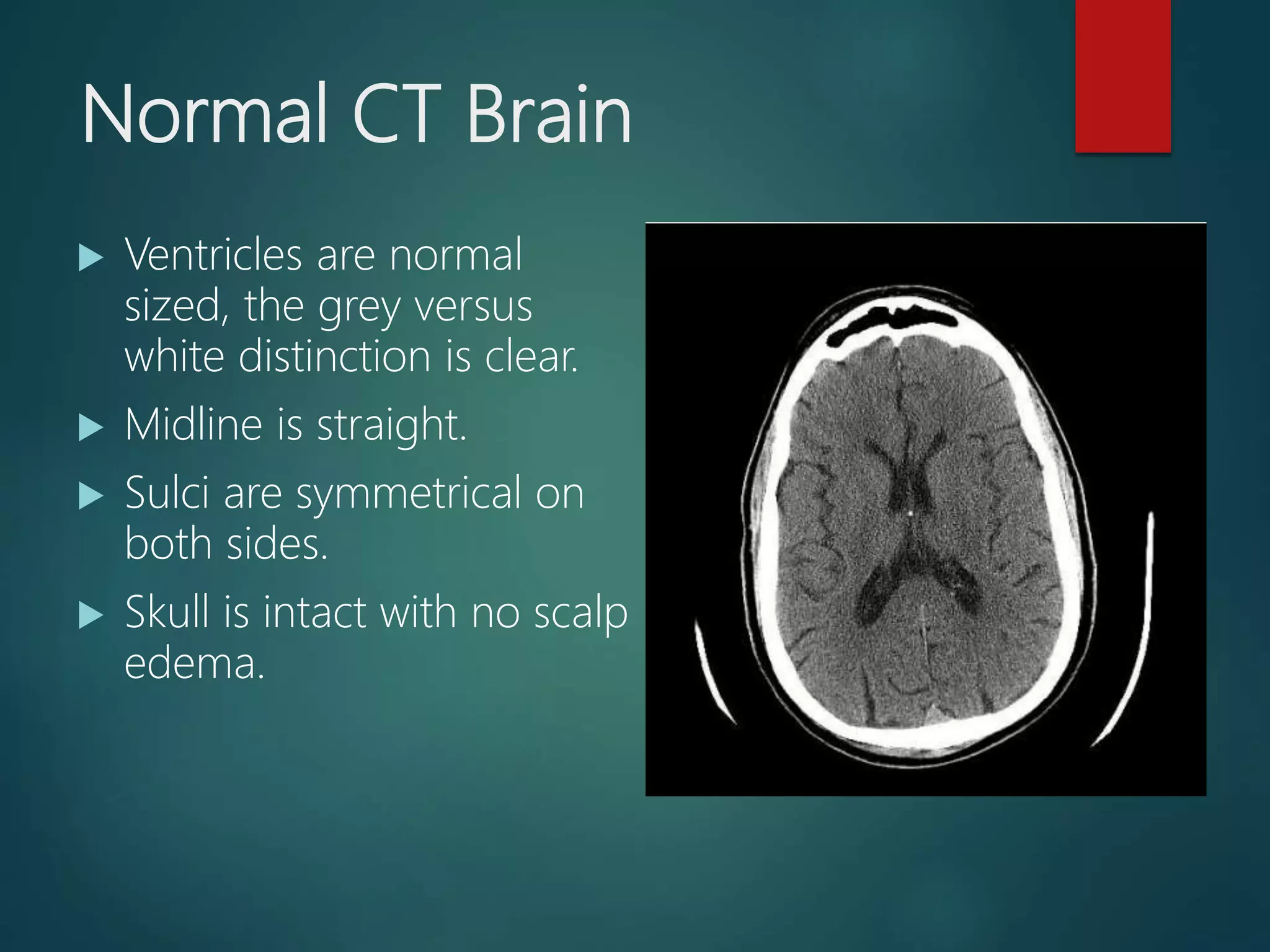 CT Brain interpretation | PPTX