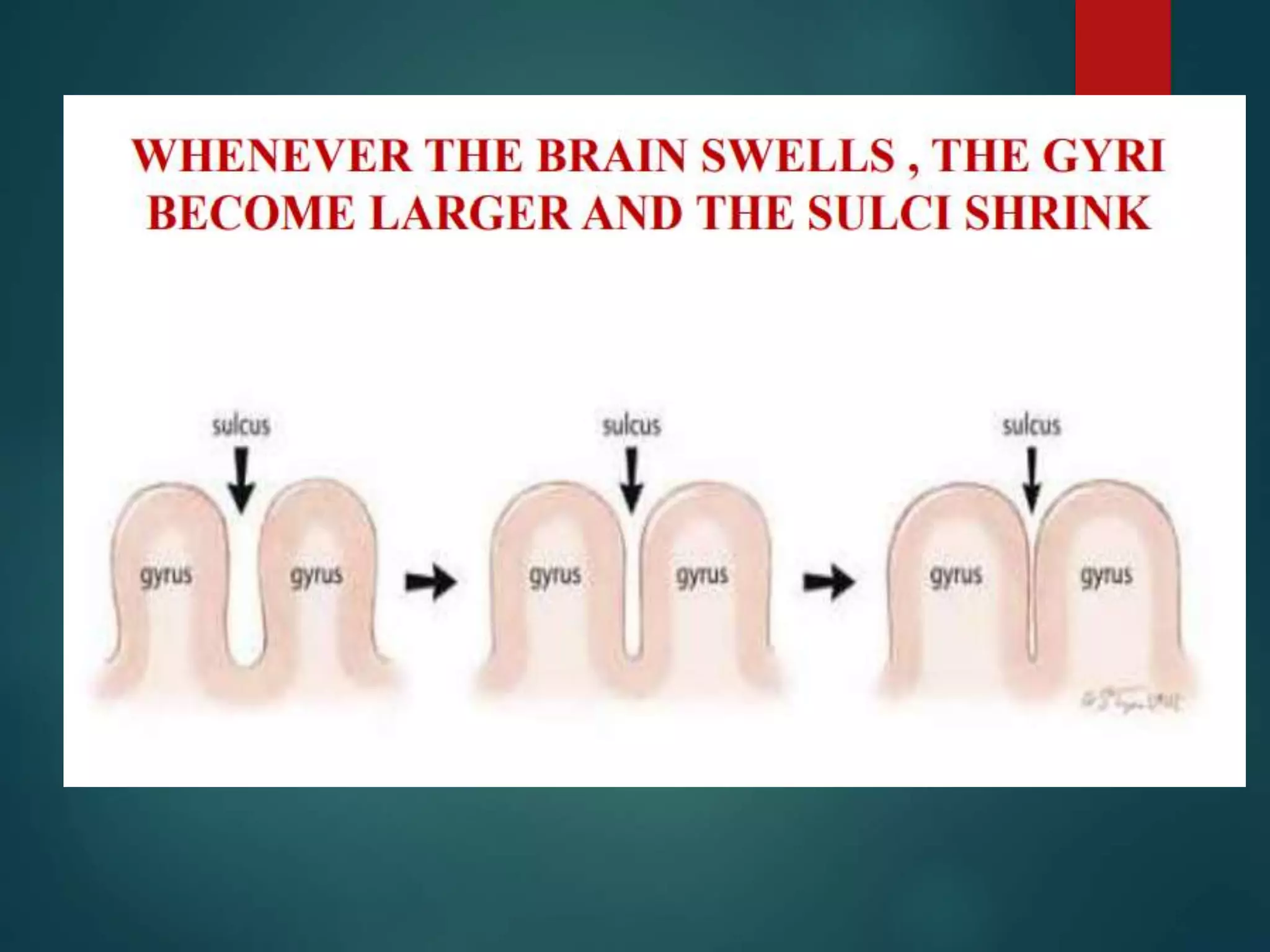 CT Brain interpretation | PPTX