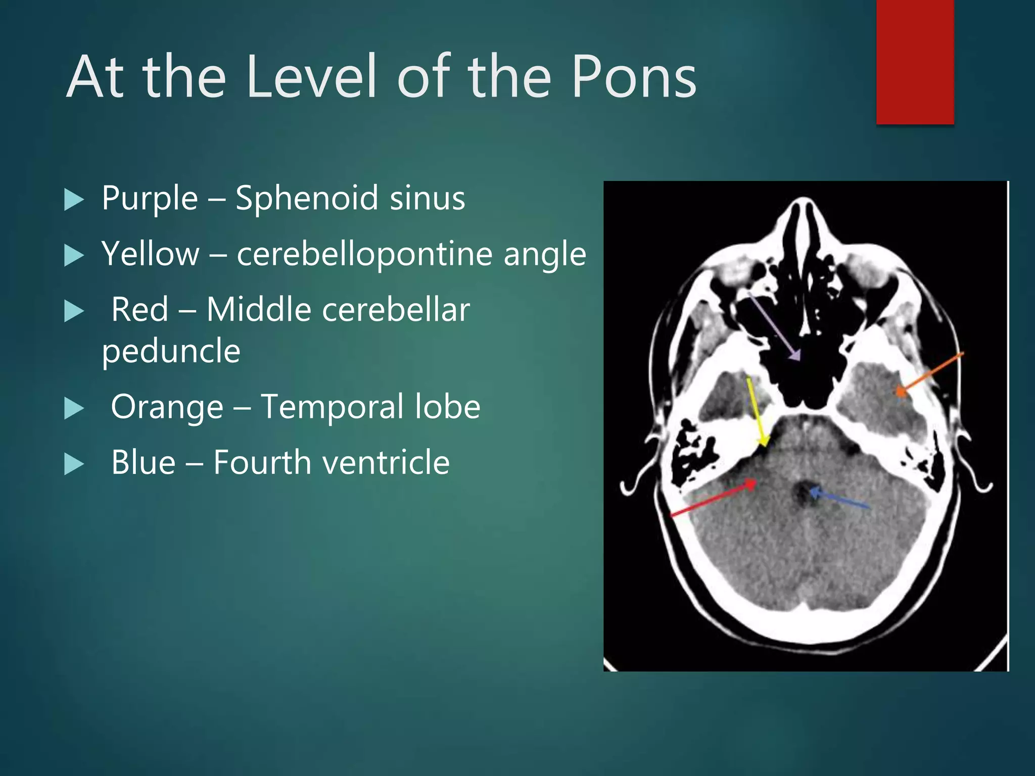 CT Brain interpretation | PPTX