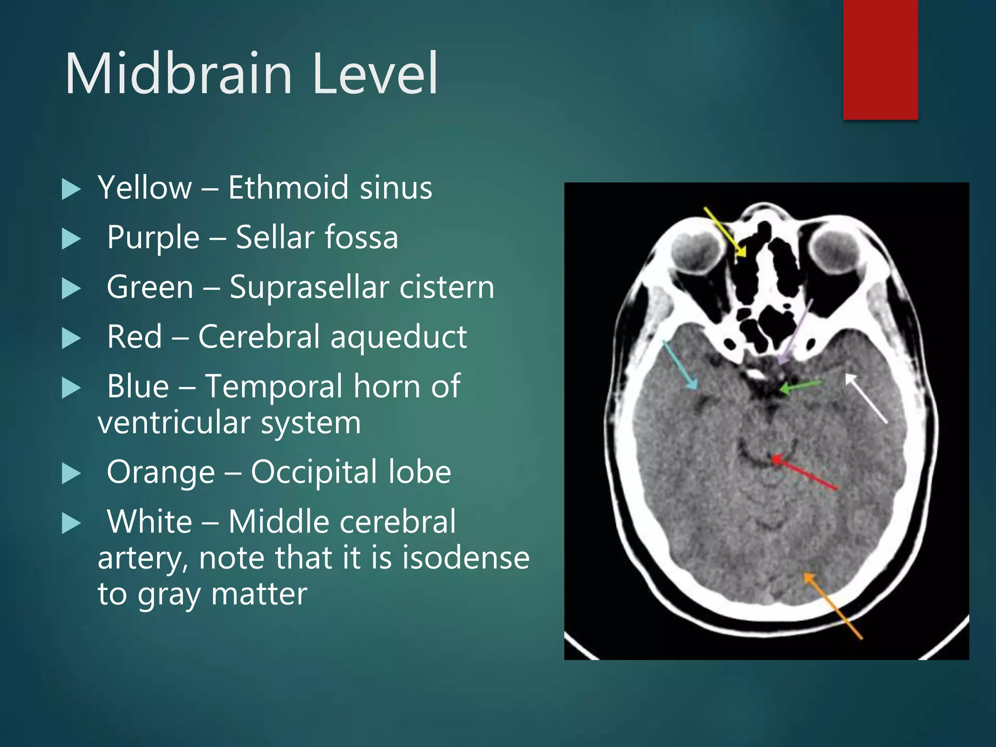 CT Brain interpretation | PPTX