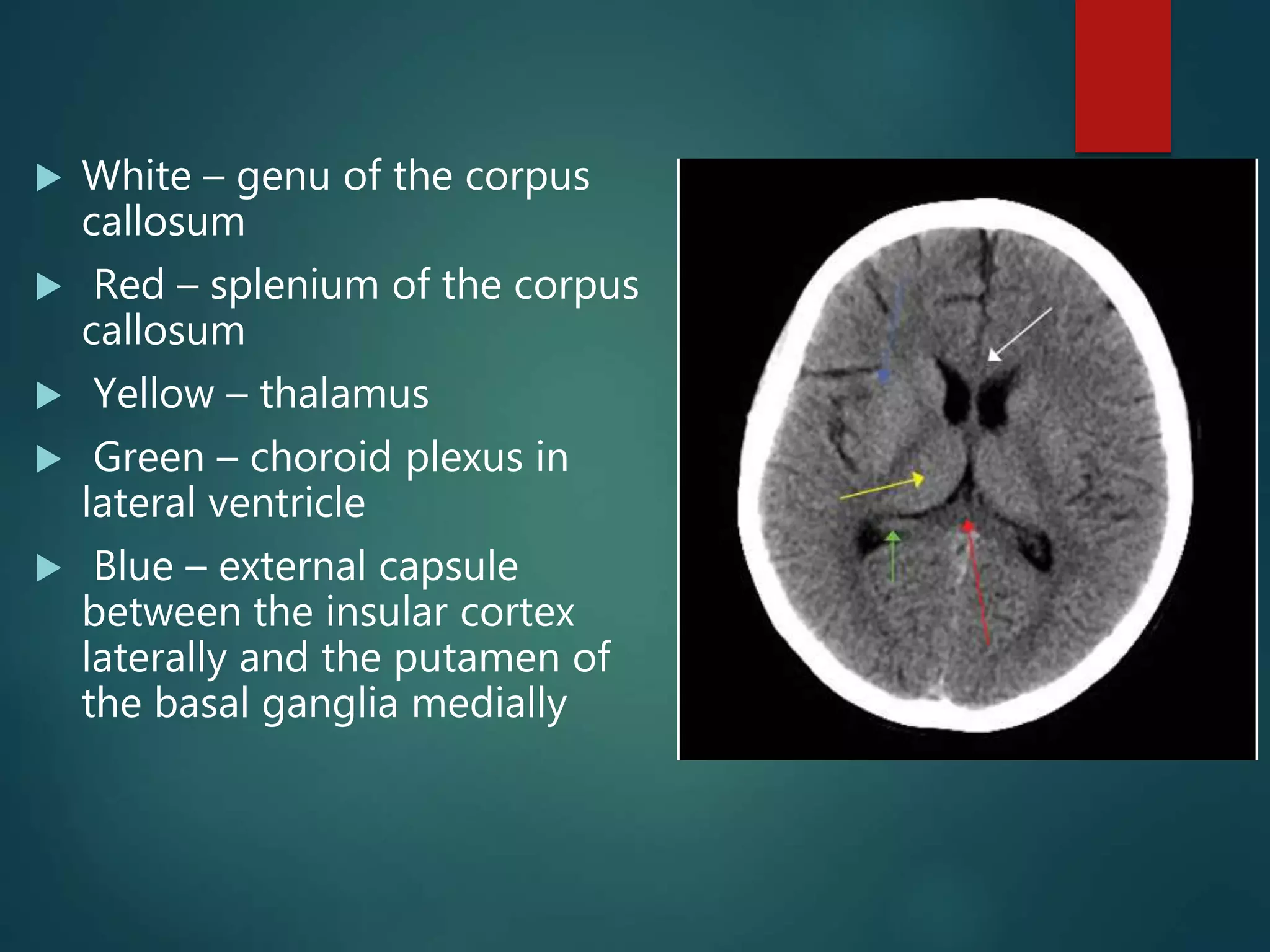 CT Brain interpretation | PPTX