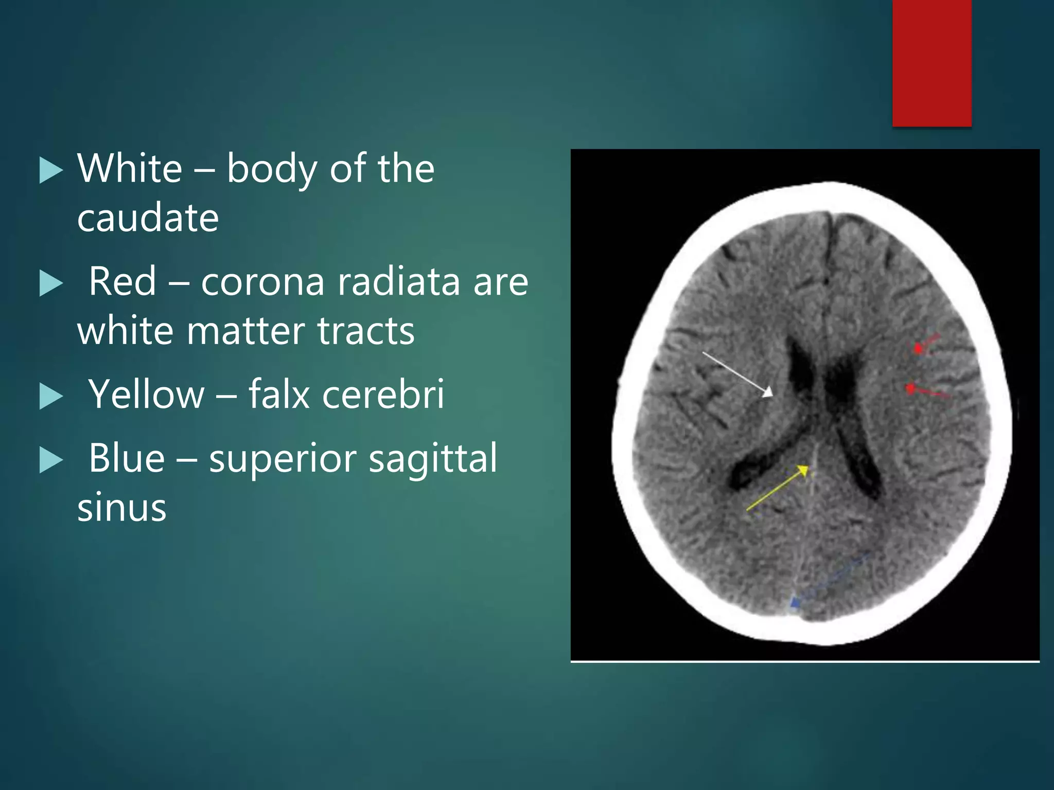 CT Brain interpretation | PPTX