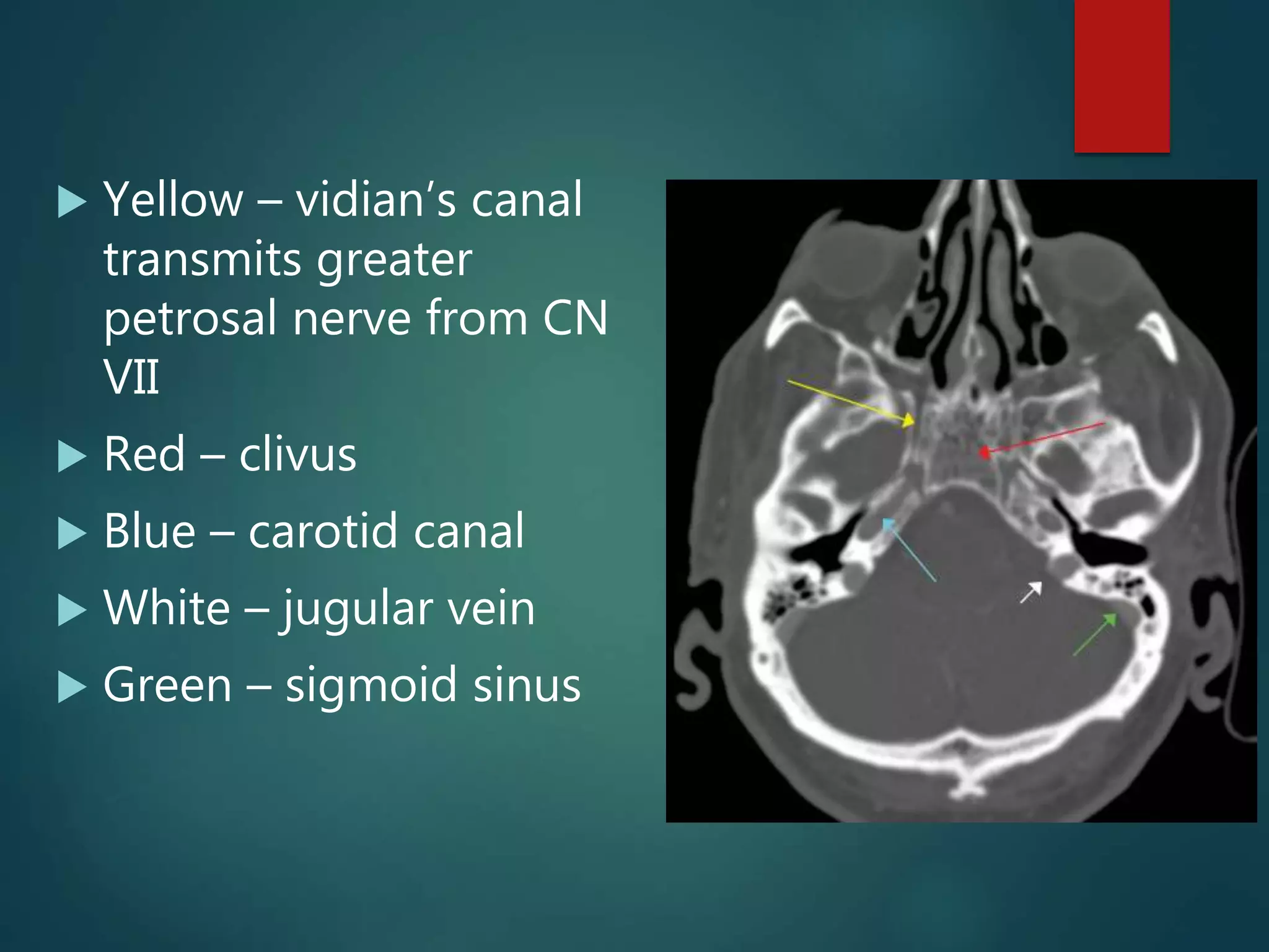 CT Brain interpretation | PPTX