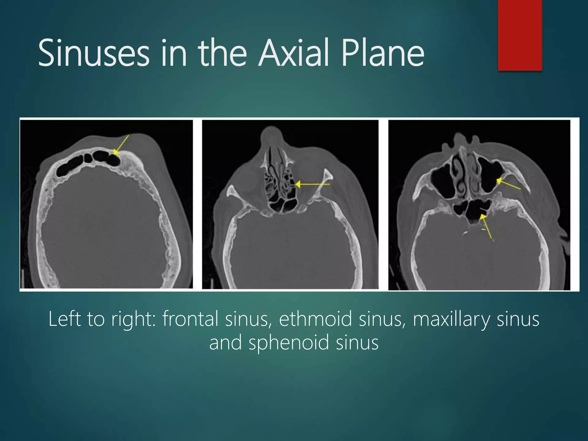 CT Brain interpretation | PPTX