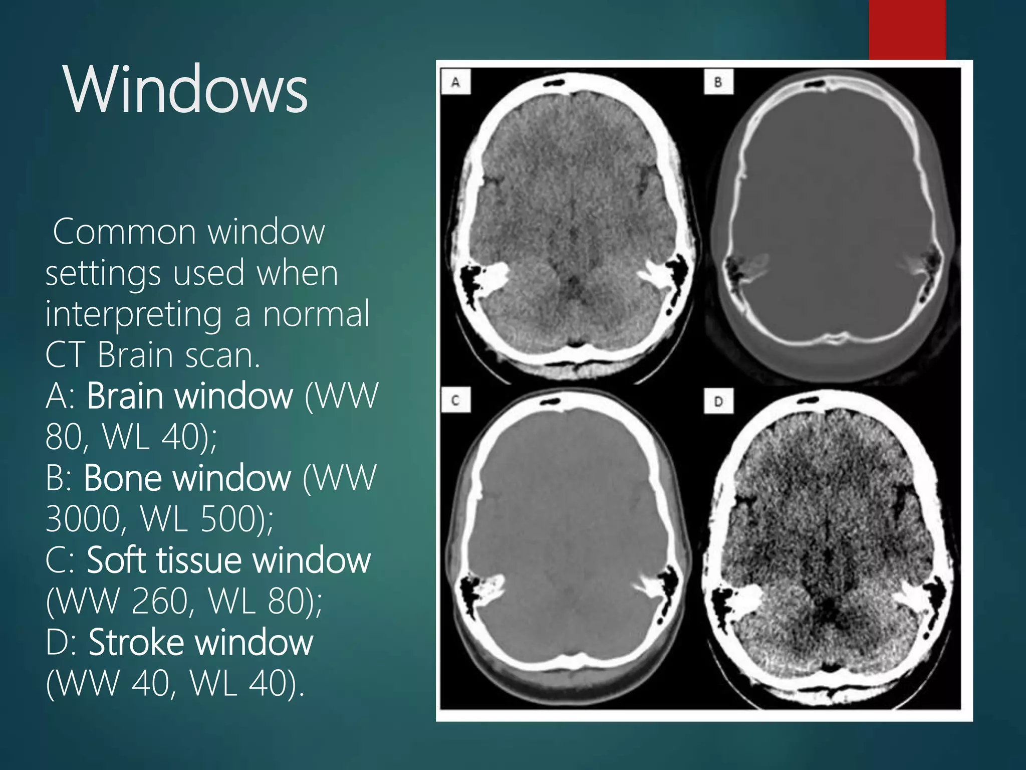 CT Brain interpretation | PPTX
