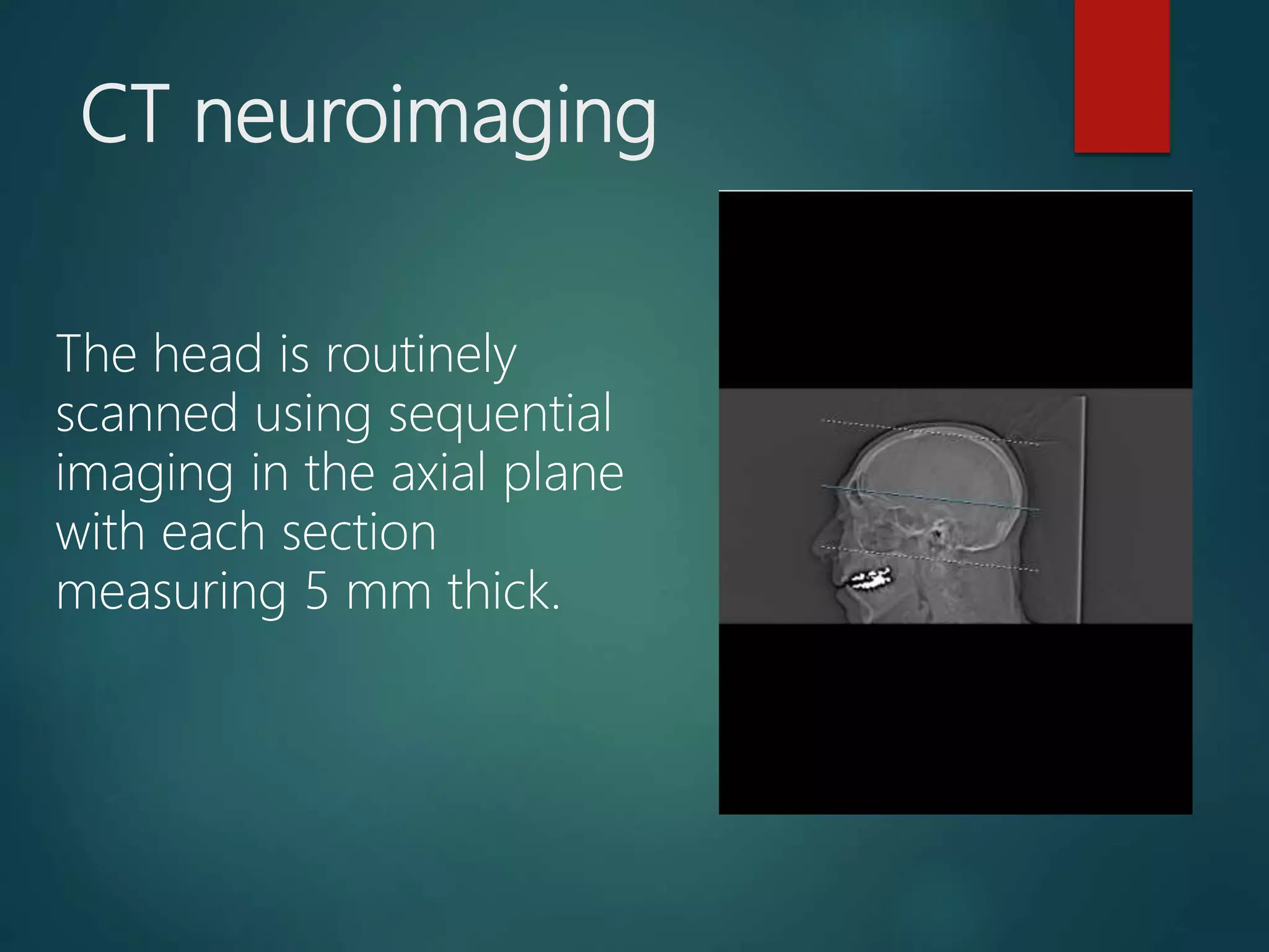 CT Brain interpretation | PPTX