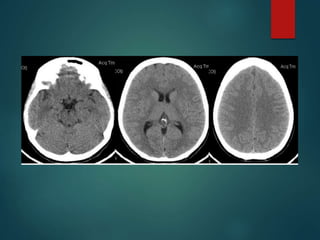 CT Brain interpretation | PPTX