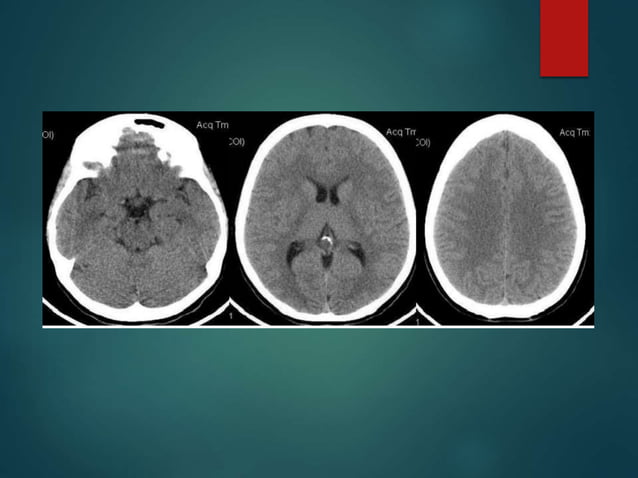 CT Brain interpretation | PPTX | Ear, Nose and Throat Conditions ...