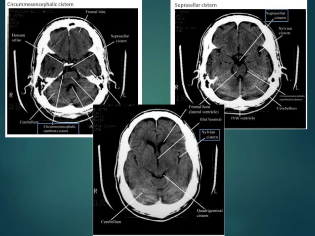 CT Brain interpretation | PPTX | Ear, Nose and Throat Conditions ...