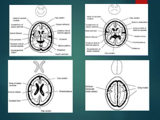 CT Brain interpretation | PPTX