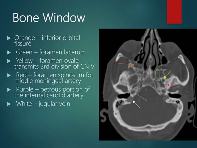 CT Brain interpretation | PPTX | Ear, Nose and Throat Conditions ...