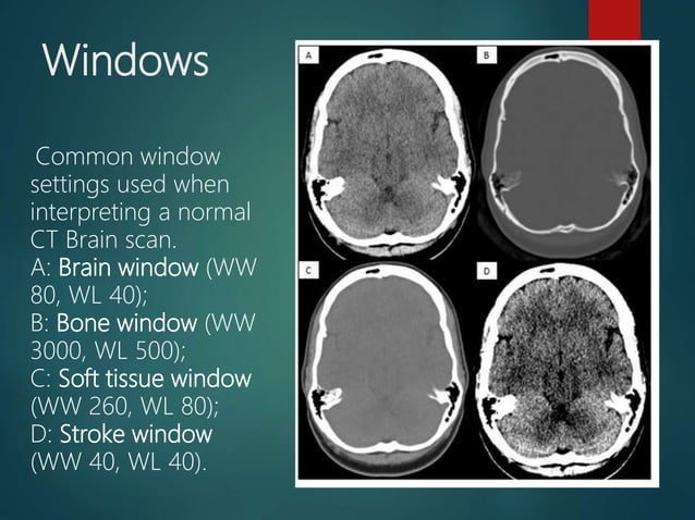 CT Brain interpretation | PPTX | Ear, Nose and Throat Conditions ...