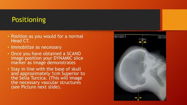 Ct Brain Perfusion - Toshiba Aquilion 64 | PPTX